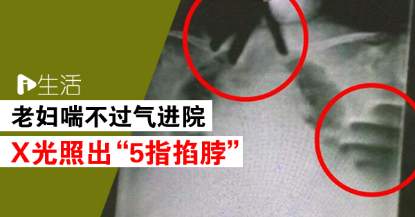 阿嬷住院突喘不过气、心律不整！X光照出诡影“5指掐脖” | 新生活报 - ILifePost爱生活