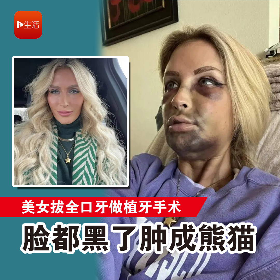 美女拔全口牙做植牙手术脸都黑了肿成熊猫 | 新生活报 - ILifePost爱生活