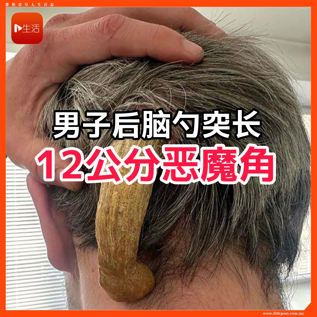 男子后脑勺突长 12公分恶魔角 | 新生活报 - ILifePost爱生活